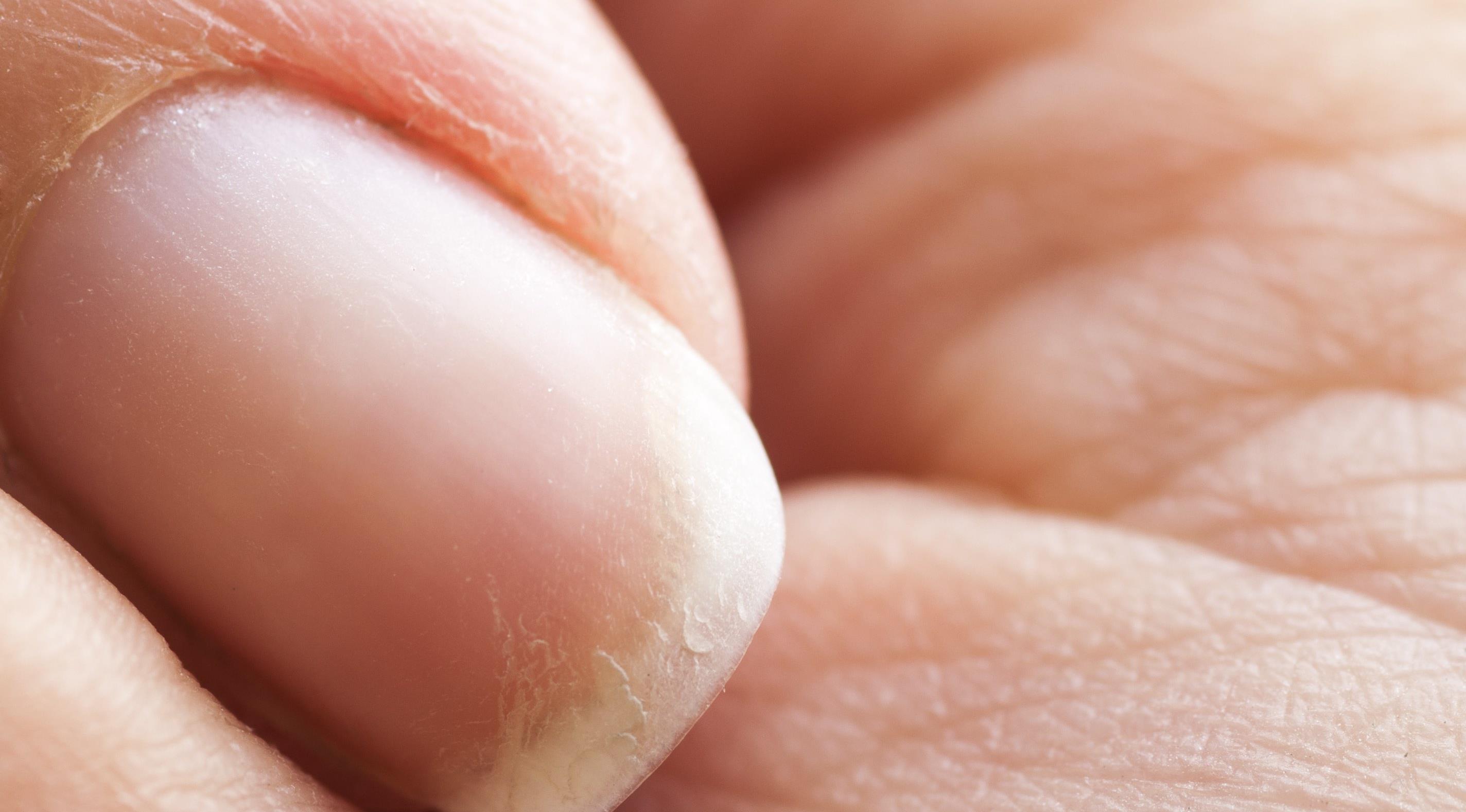 Dehydration tops list of nail complaints among Brits